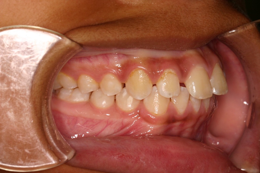 spacing initial - Pollei OrthodonticsPollei Orthodontics